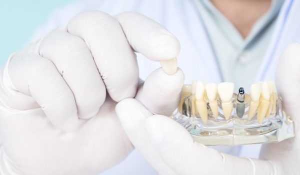 What are micro - implants? - www.greatsmile.gr