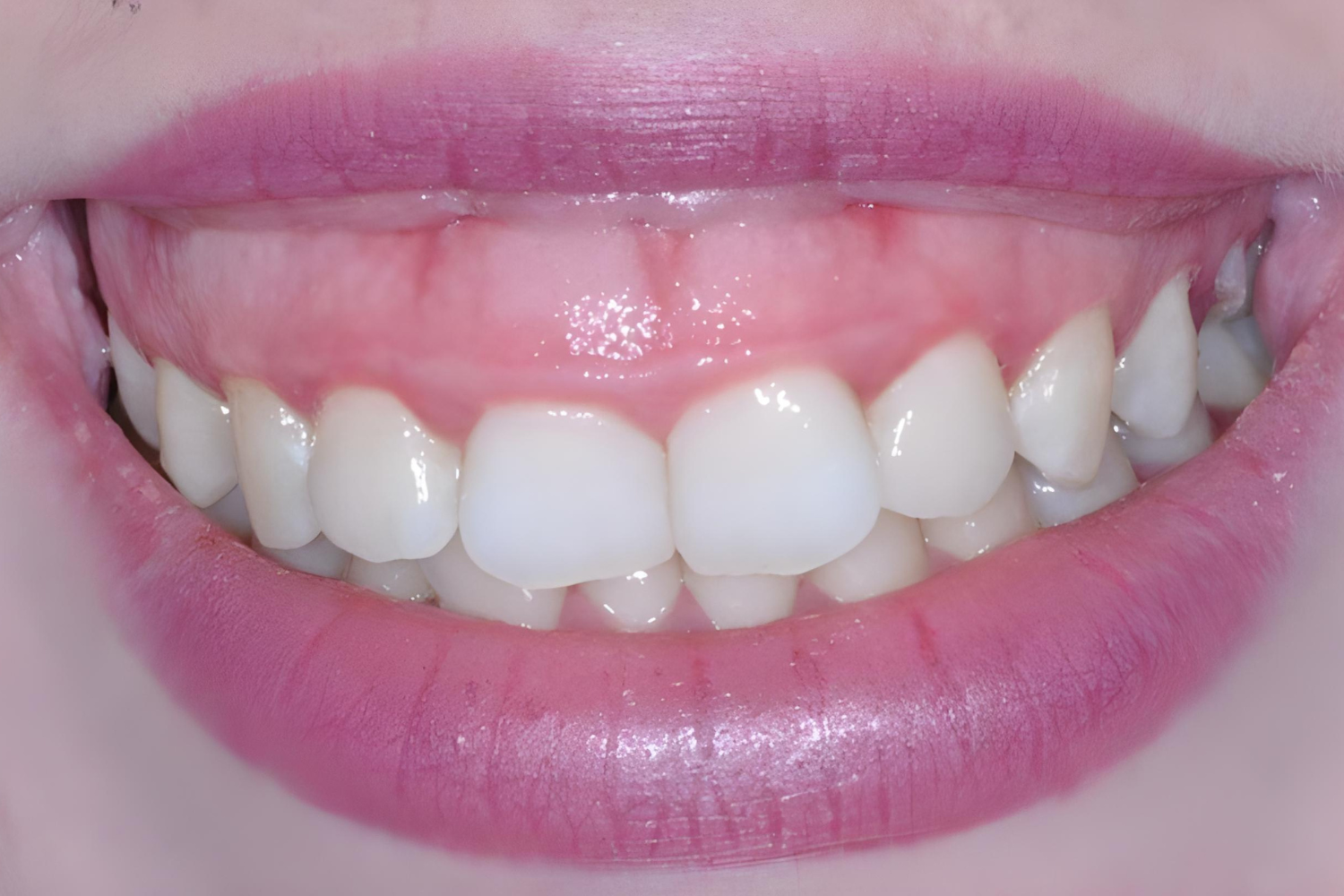 Gummy smile correction via orthodontic treatment - www.greatsmile.gr